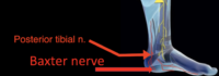 Baxter’s Neuropathy