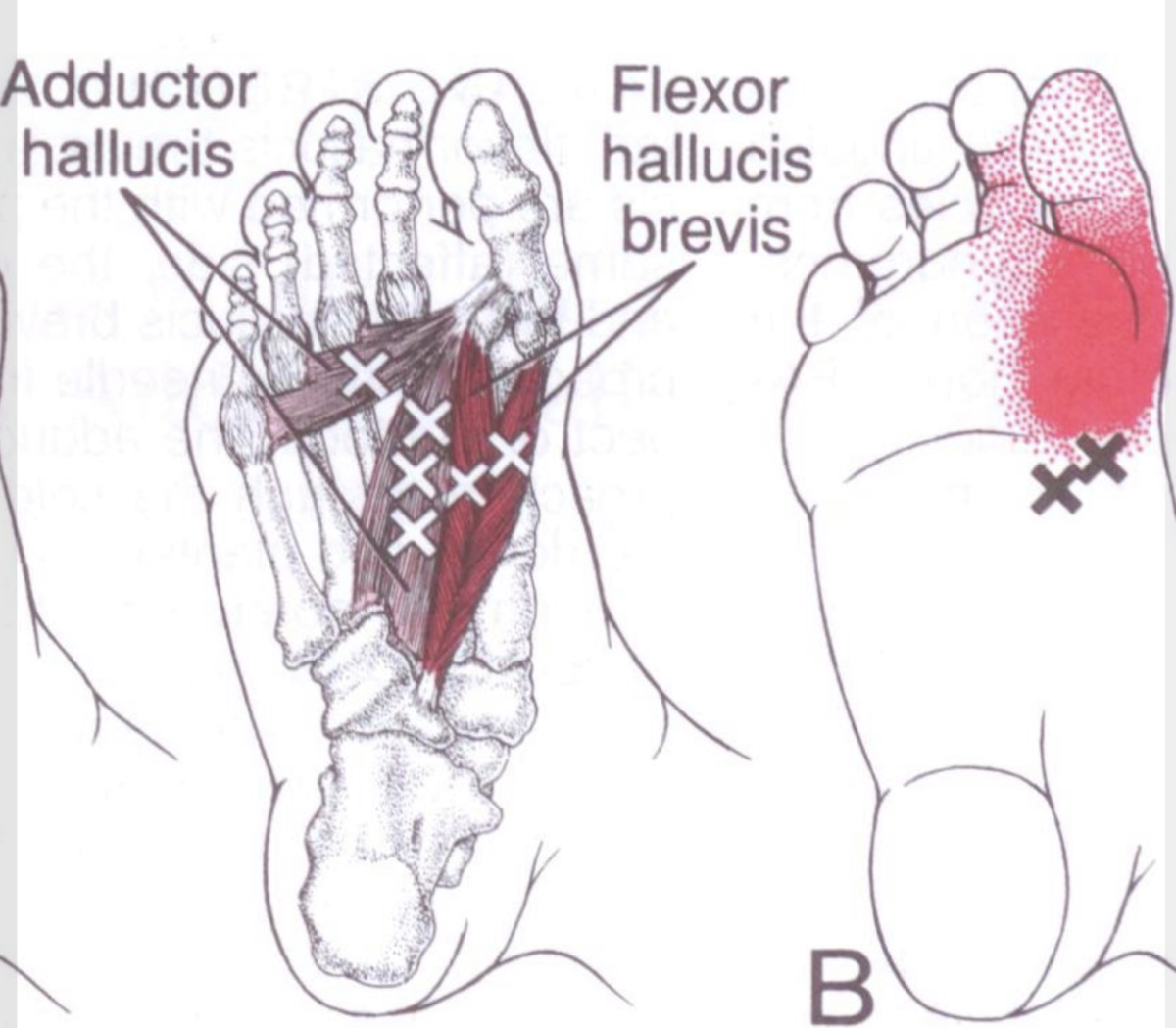Adductor Hallucis: Weakness Causes Painful toes, Arch and Creates ...