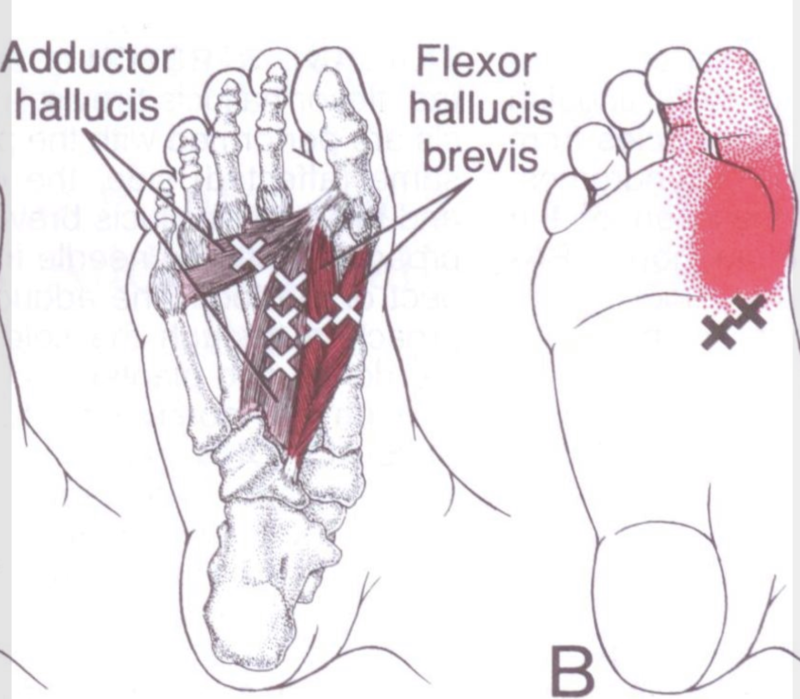 Adductor Hallucis: Weakness Causes Painful toes, Arch and Creates ...