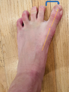 Adductor Hallucis: Weakness Causes Painful toes, Arch and Creates ...