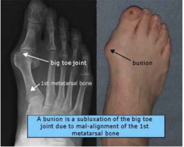 Big Toe Pain: 5 Causes of a Painful Big Toe - Dr. Justin Dean