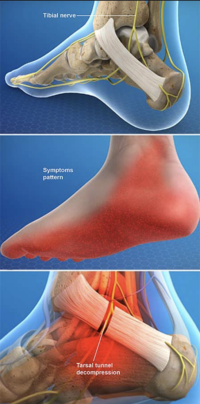Flexor Retinaculum of the Foot: Retinacula Injuries and Treatment - Dr ...