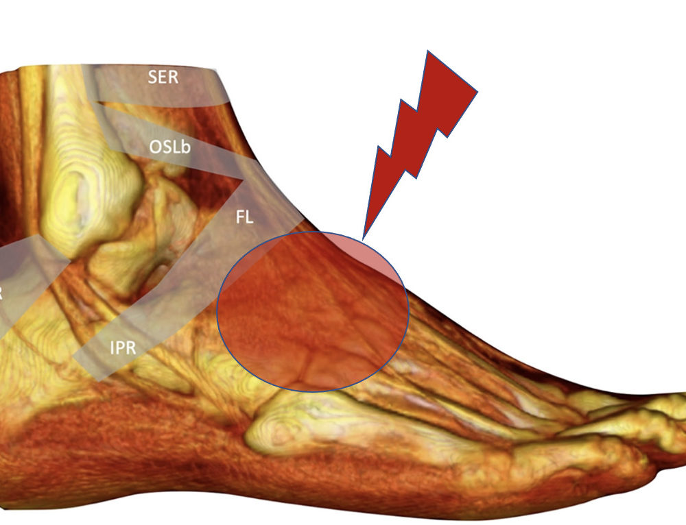 Second Toe Pain: Capsulitis of the Second Toe - Dr. Justin Dean