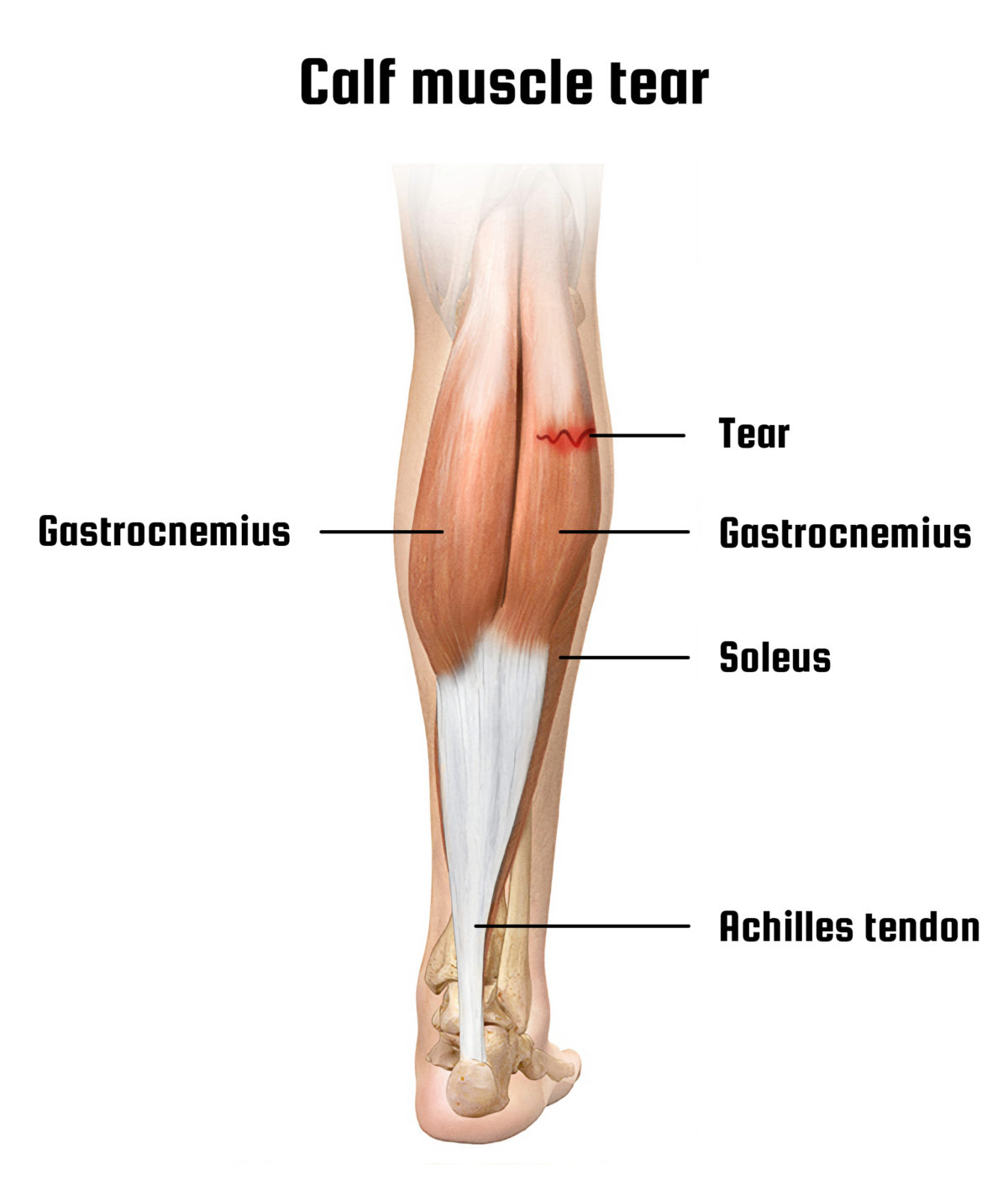 Gastrocnemius Tear Calf Strain Dr Justin Dean