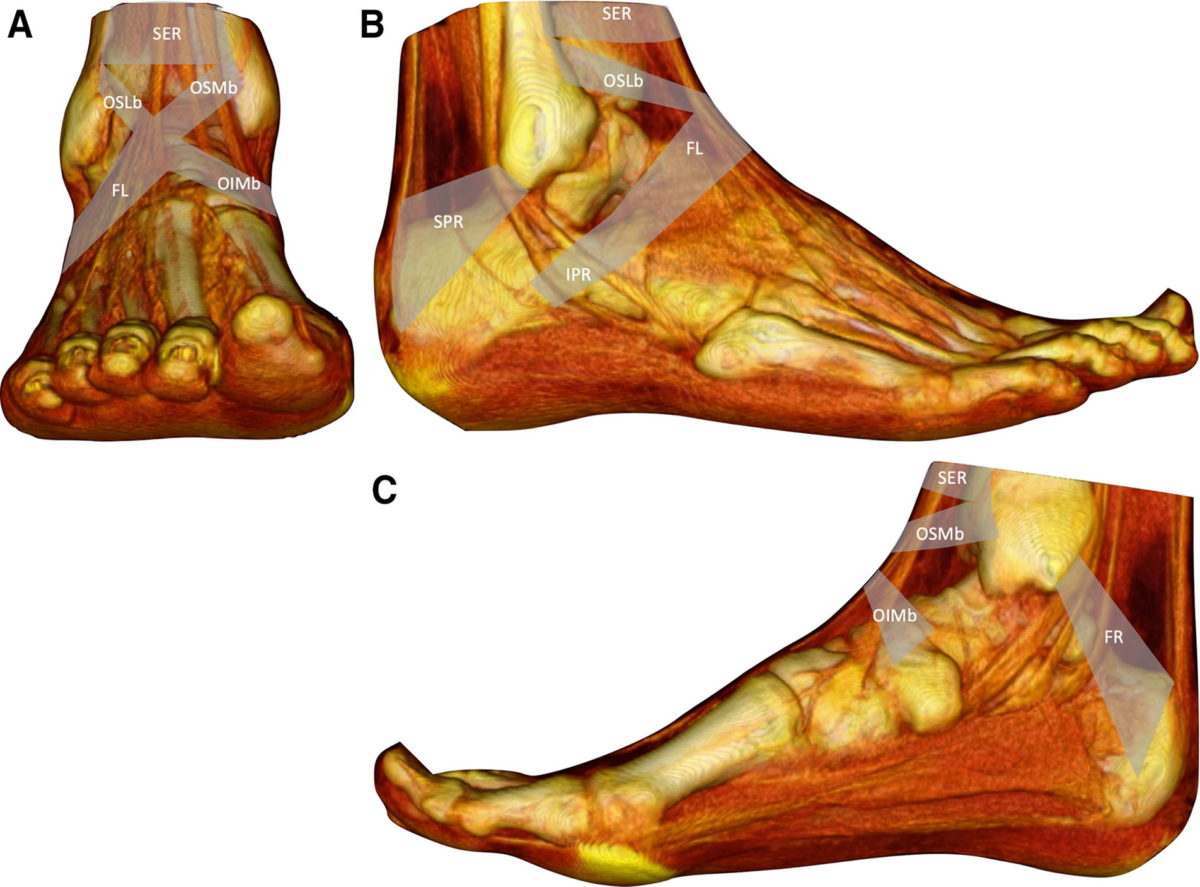 Ankle Tendonitis: Peroneal or Achilles Tendon?