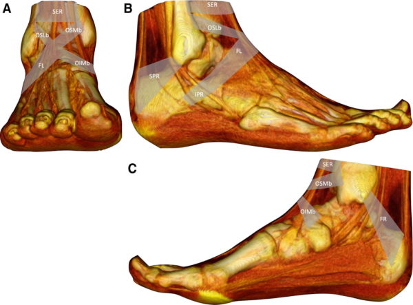 Ankle Tendonitis: Peroneal or Achilles Tendon?
