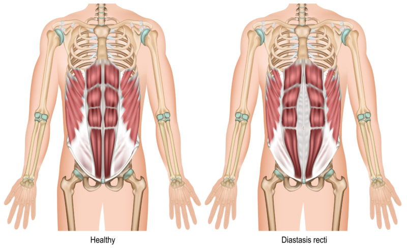 Linea Alba: The White Line (Abdominal)