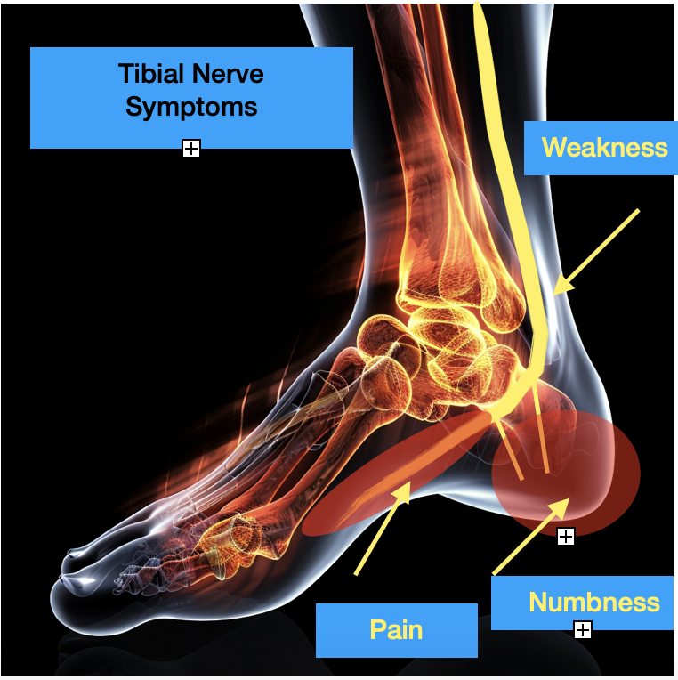 Tibial Nerve Damage Symptoms: Discover the Symptoms of Tibial Nerve ...